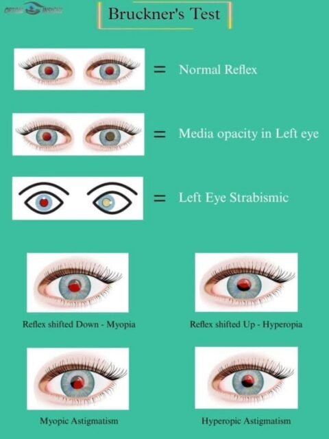 Procedure of Bruckner Test - Being an Optometrist